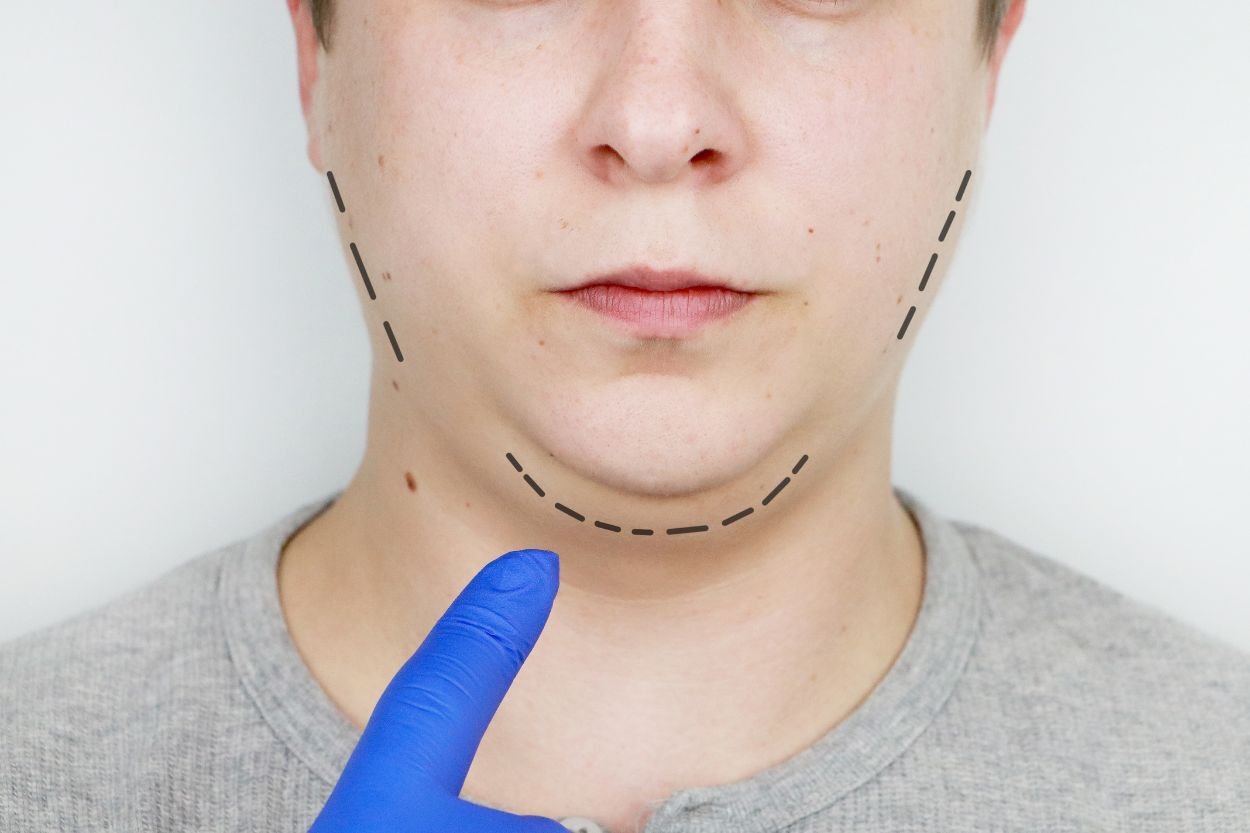 Best Chin Surgery 2024 Colombia - Plastic Surgeon Medellin